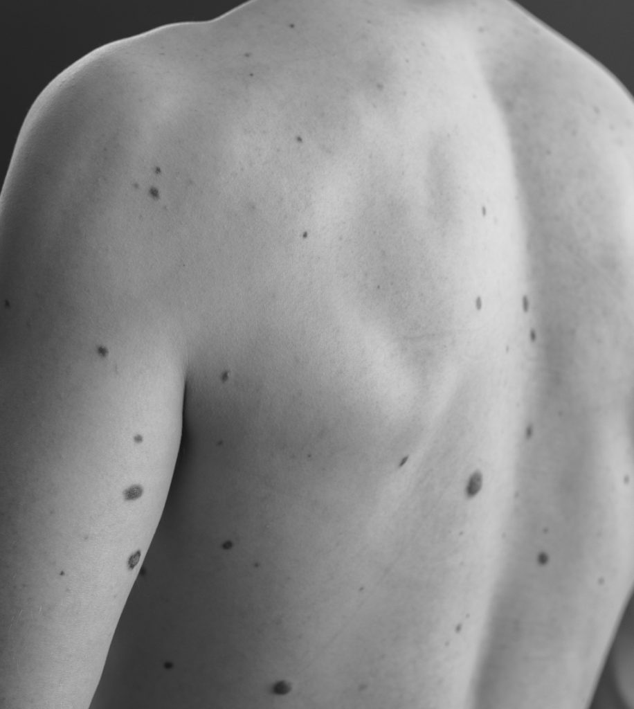 Molemap & Skin Cancer Check Sydney | HHMP